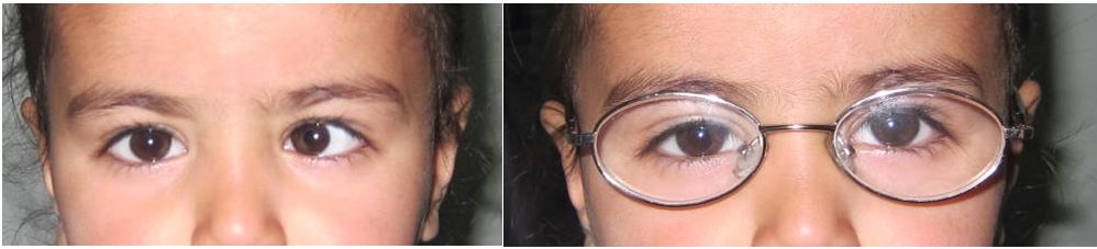 CROSS EYE (STRABISMUS) IN CHILDREN AND ITS TREATMENT | Op. Dr. Hüseyin Acar